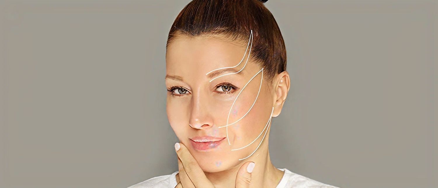 What Is the Recovery Time of PDO Threads Lift?